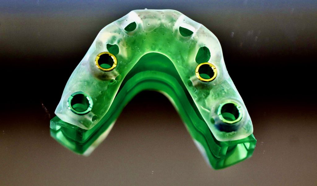 S2 Surgical Guide - 4+ Implant Treatment - S3 Simple Smile Solutions ...