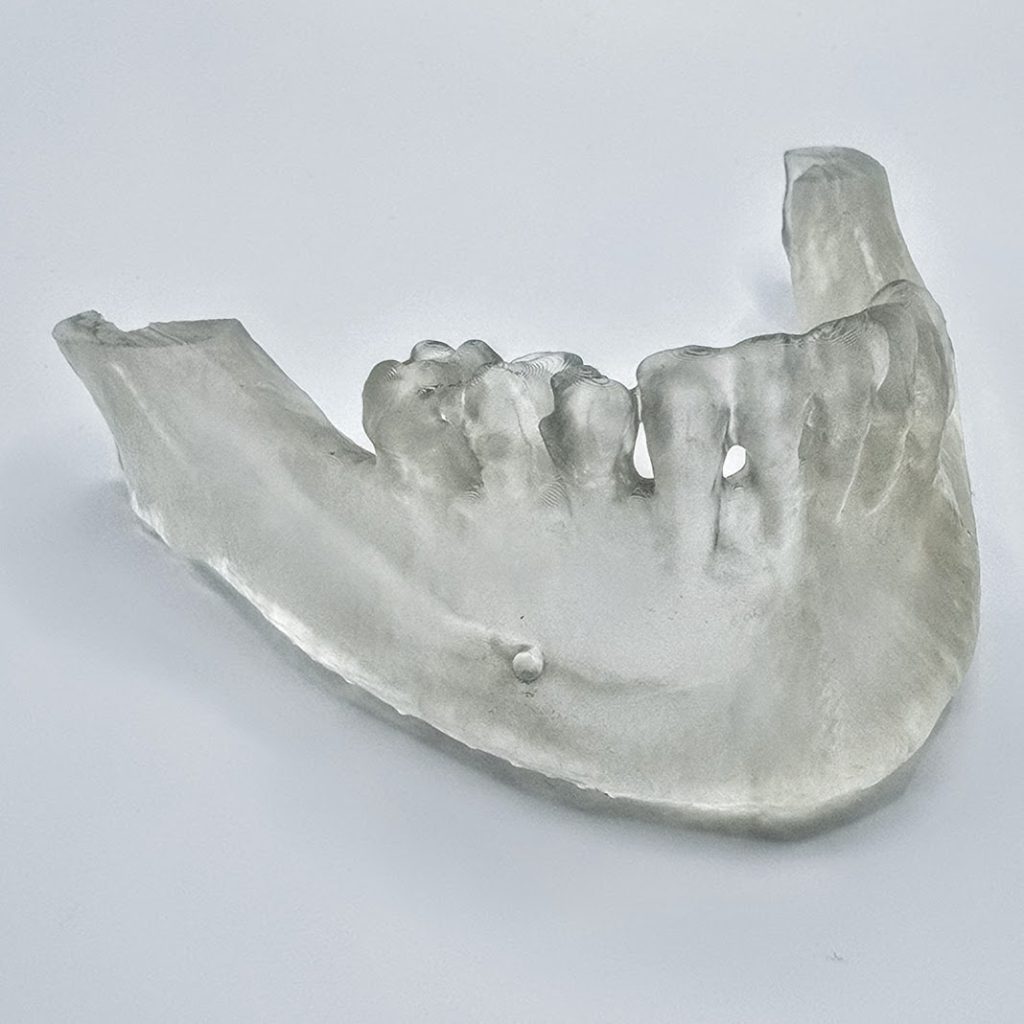 Lower Mandible Model - S3 Simple Smile Solutions | S3 Smiles